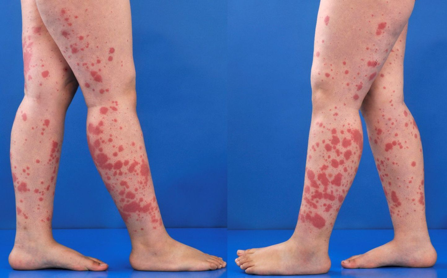 Memahami Henoch-Schönlein Purpura: Panduan untuk Orang Tua – Bhyllabus ...