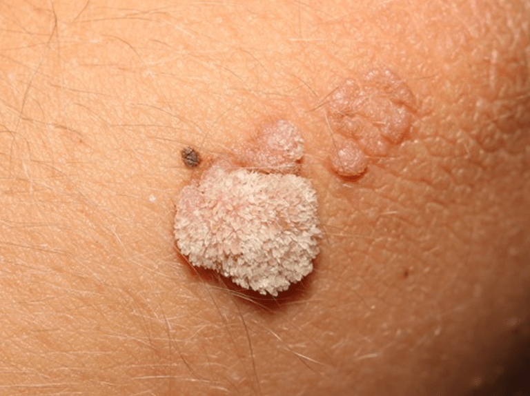Memahami Veruka Vulgaris: Kutil Biasa yang Sering Diabaikan – Bhyllabus ...