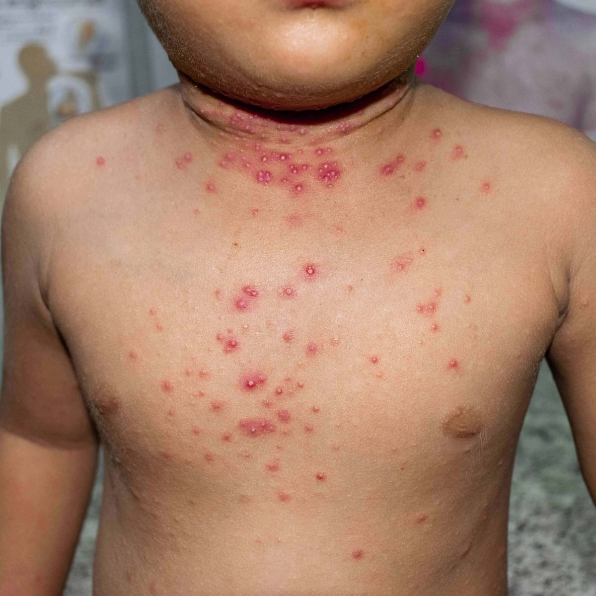 Memahami Moluskum Kontagiosum: Infeksi Kulit yang Perlu Diketahui ...