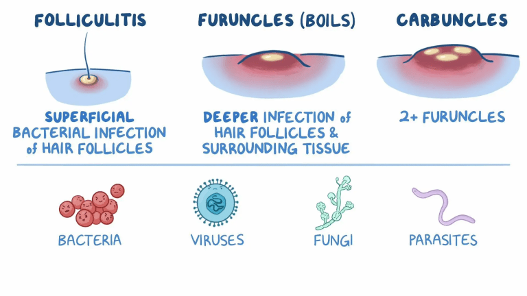 Mengenal Furunkel dan Karbunkel: Infeksi Kulit yang Nyeri dan ...
