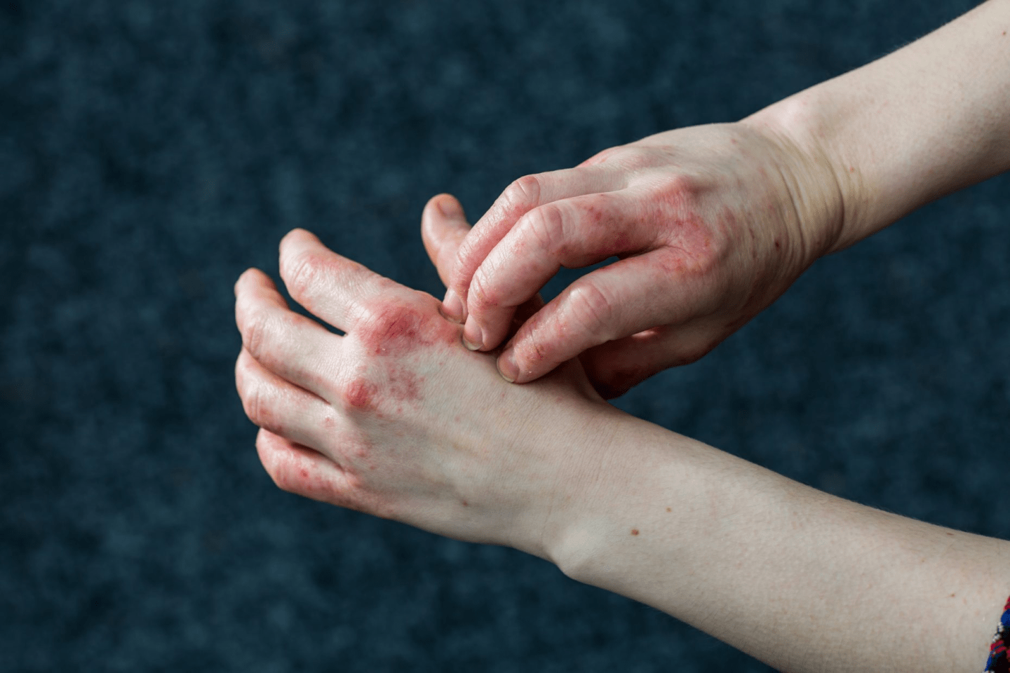 Gejala dan Pengobatan Dermatitis Kontak Iritan – Bhyllabus l'énigme